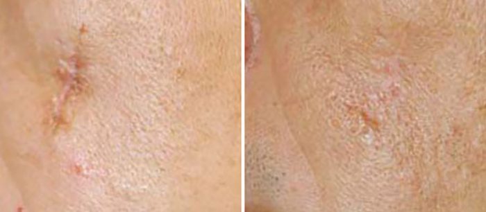 Trauma / Scar Revision - Dr. Harinder S. Chahal MD