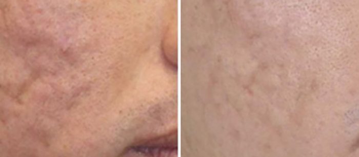 Trauma / Scar Revision - Dr. Harinder S. Chahal MD