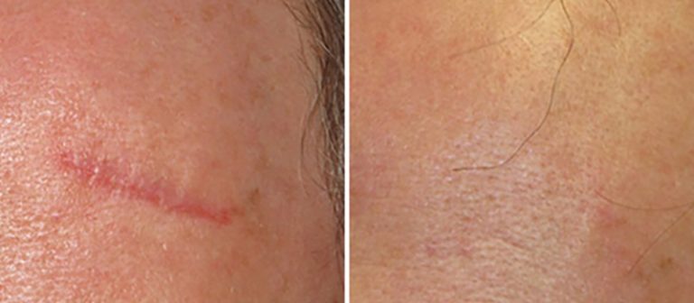 MMA Fighters and Recurrent Facial Injury - Dr. Harinder S. Chahal MD