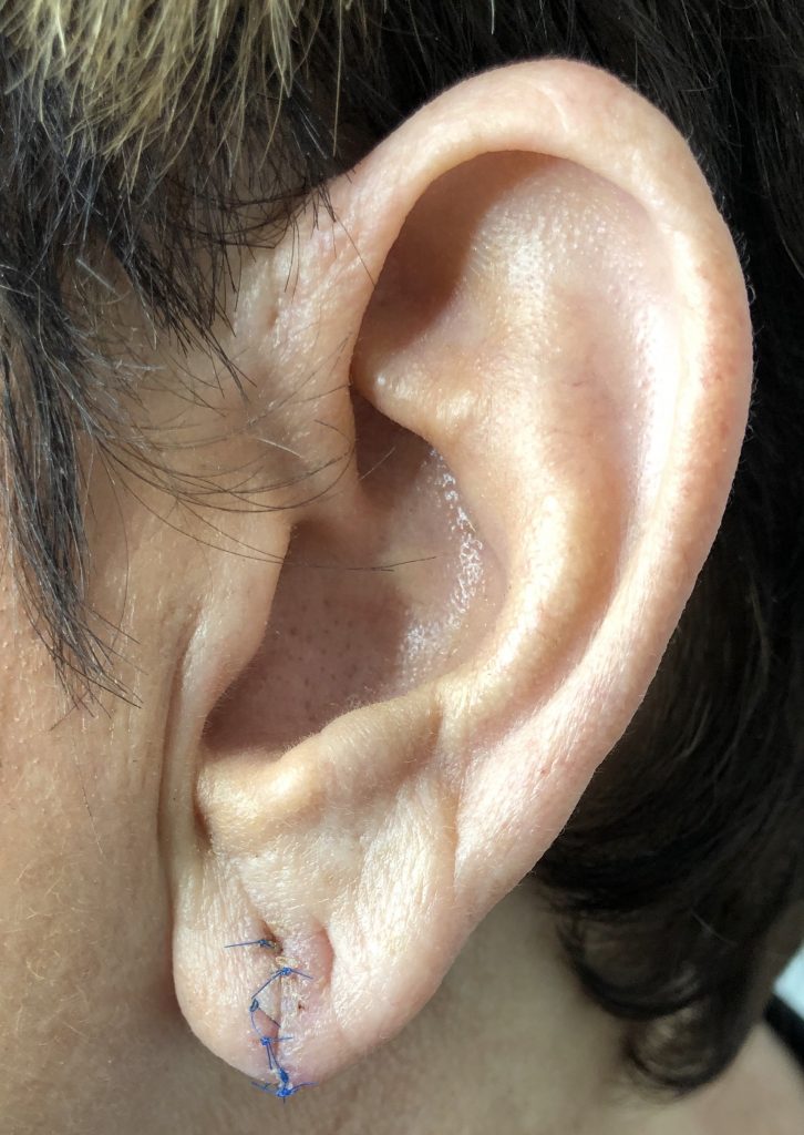 Torn Earlobes / Earlobe Repair - Dr. Harinder S. Chahal MD