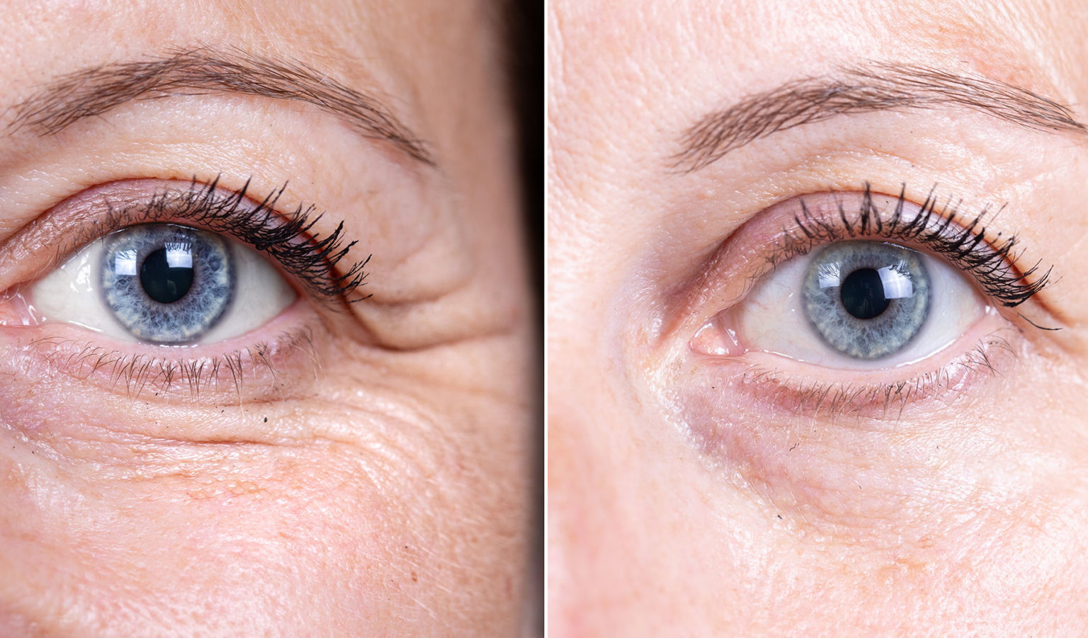 Droopy Eyelid Archives - Dr. Harinder S. Chahal MD