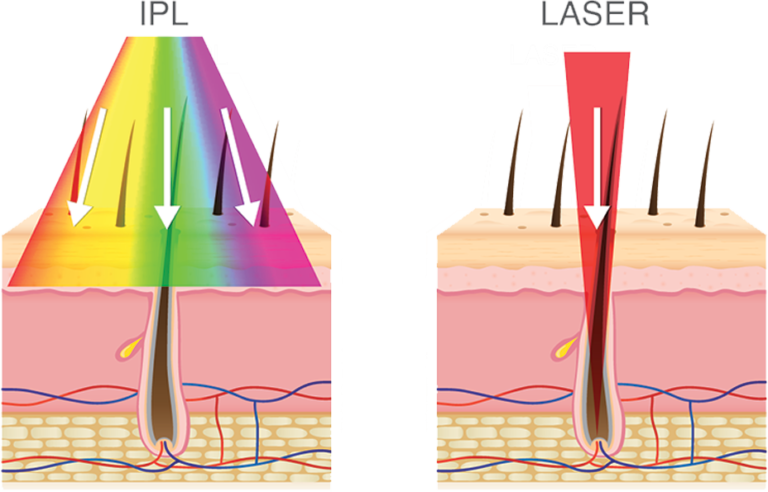 Intense Pulsed Light (IPL) - Dr. Harinder S. Chahal MD