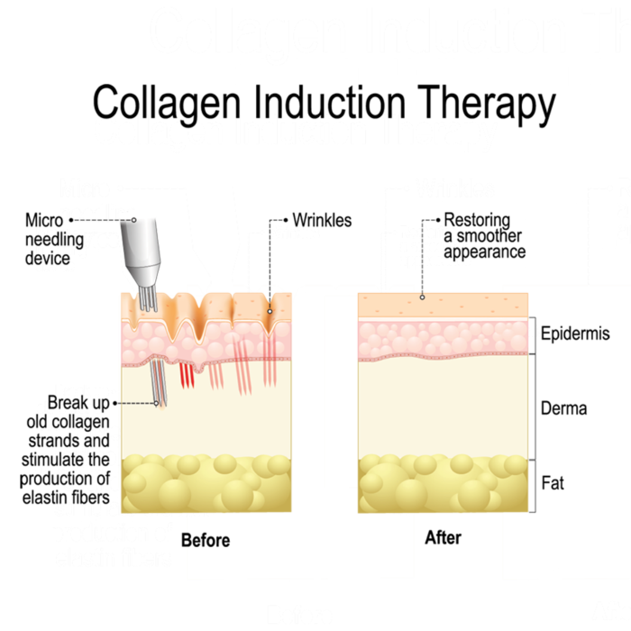 Microneedling - Dr. Harinder S. Chahal MD