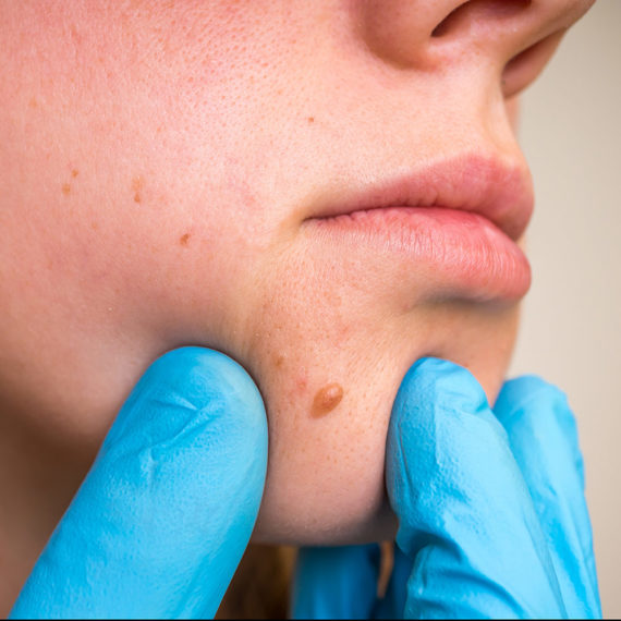Skin Growth Removal - Dr. Harinder S. Chahal MD