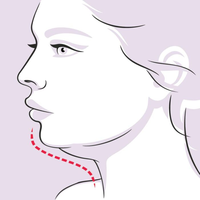 Kybella - Dr. Harinder S. Chahal MD