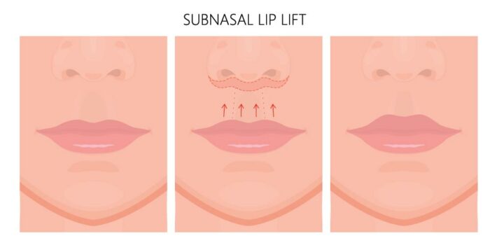 Lip Lift Surgery - Dr. Harinder S. Chahal MD Lip Lift Surgery - Dr. Harinder S. Chahal MD